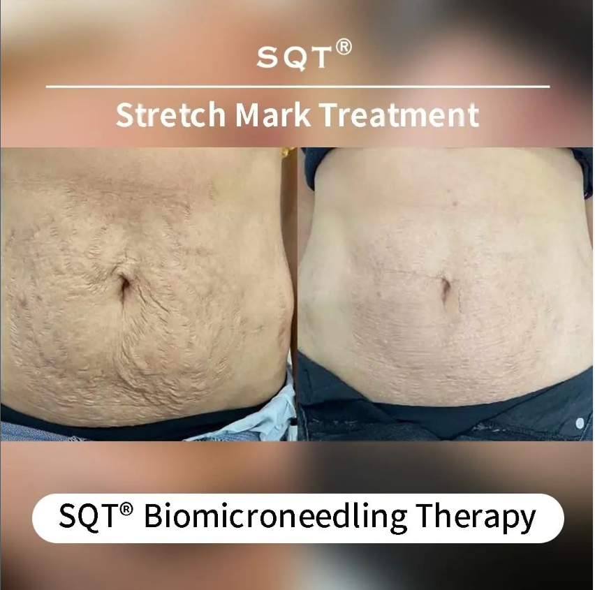 SQT Bio Microneedling